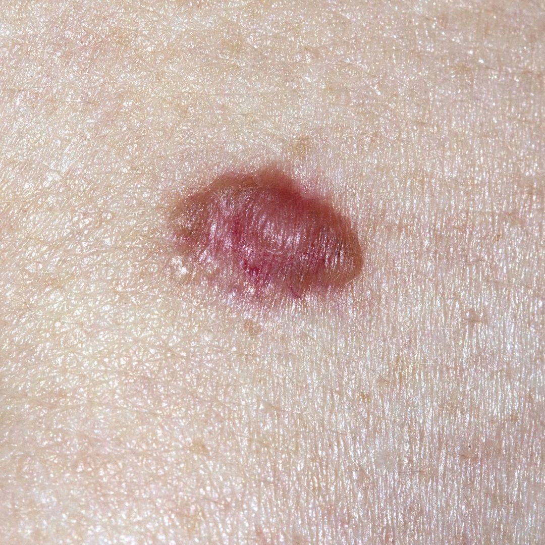 Carcinomul bazocelular – Dermaceutica – SkinCare